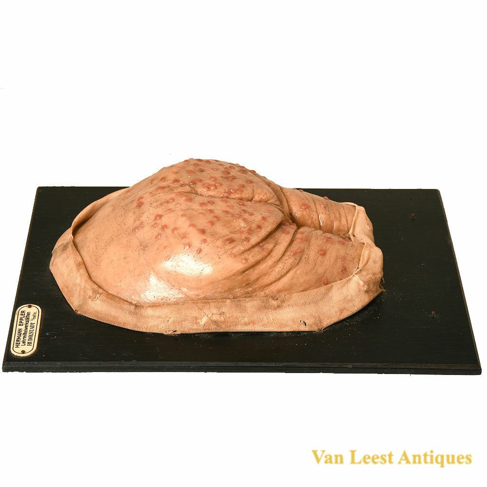 Eppler Anatomical Wax Model the measles - Van Leest Antiques
